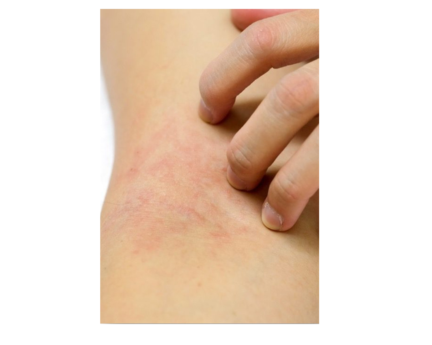 Pourquoi mon corps me gratte-t-il le soir ? | Uriage